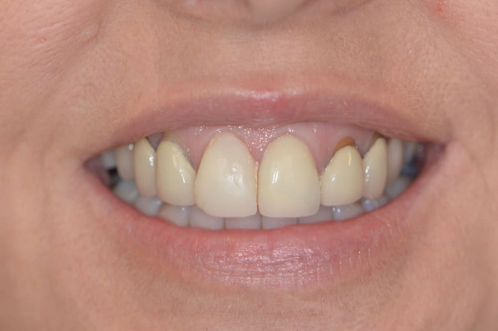 Smile Gallery | Cosmetic Dentistry | Carrie Muzny, DDS