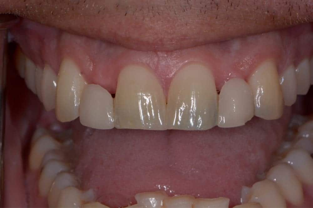 Smile Gallery | Cosmetic Dentistry | Carrie Muzny, DDS