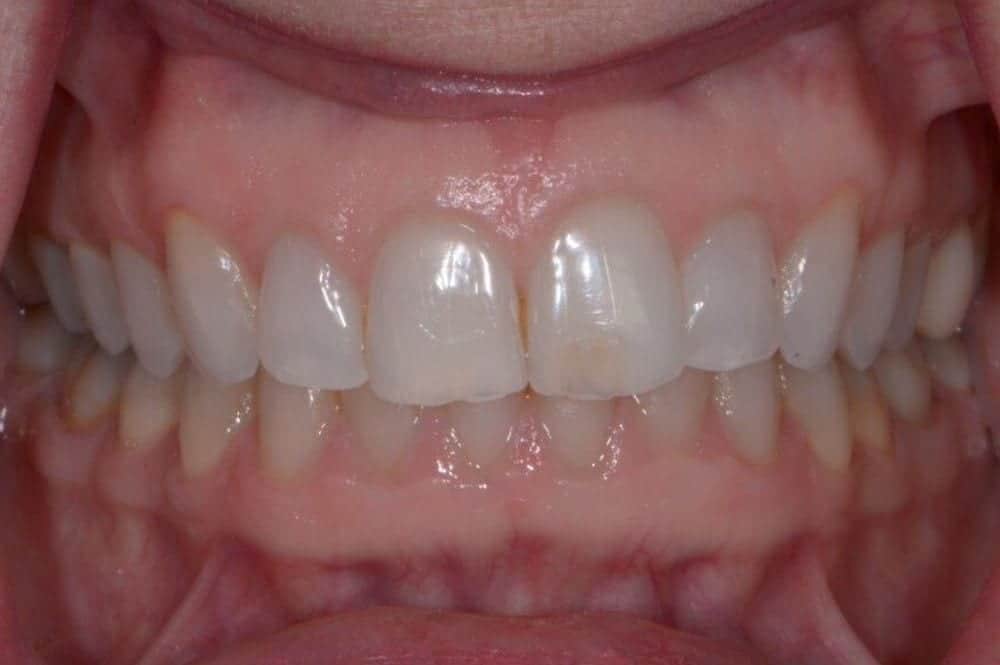 Smile Gallery | Cosmetic Dentistry | Carrie Muzny, DDS