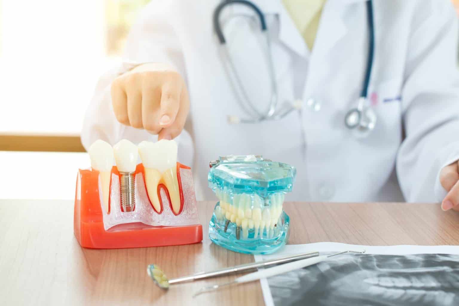 Common Dental Implants Problems And How To Avoid Them